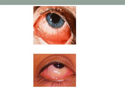 Allergic Conjunctivitispptx Ocular Surface Ppt