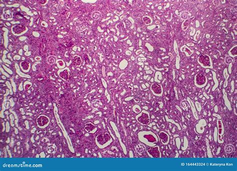 Chronic Pyelonephritis Light Micrograph Royalty Free Stock Image