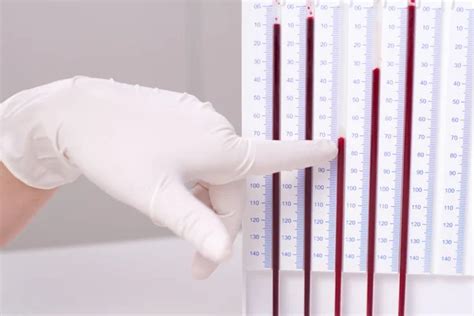 Imágenes De Velocidad De Eritrosedimentación Fotos De Velocidad De Eritrosedimentación Sin