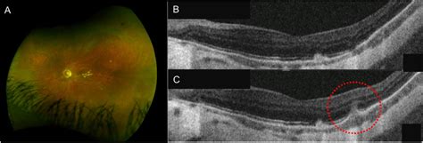Punctate Inner Choroidopathy A Left Eye Ultra Wide Field Fluorescein Download Scientific