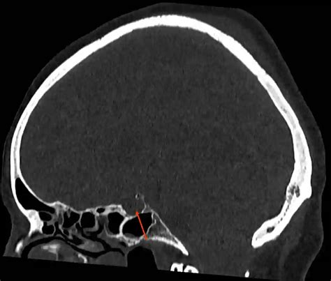 Hypophyseal Fossa Ars Neurochirurgica