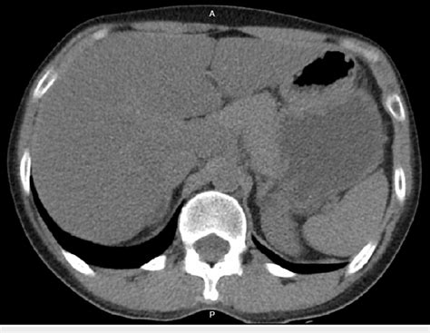 Ct Abdomen Shows Fatty Infiltration Of The Liver Without Cbd Dilatation