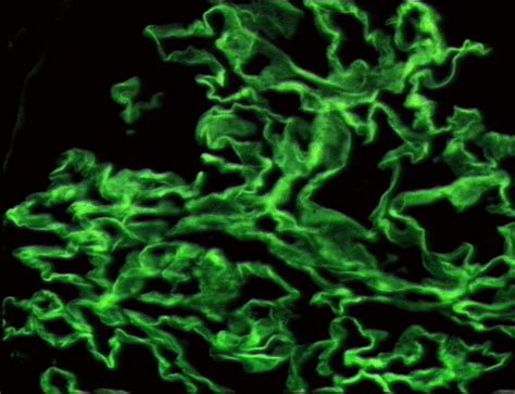 Basement Membrane Goodpasture Syndrome Nurse Jackie