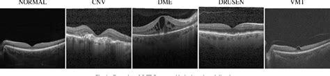 Figure 3 From Automated Classification Of Vmt Pathology From Optical Coherence Tomography B