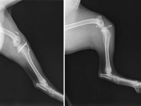 Tibial Crest Avulsion Dr Michalis Pelekanis