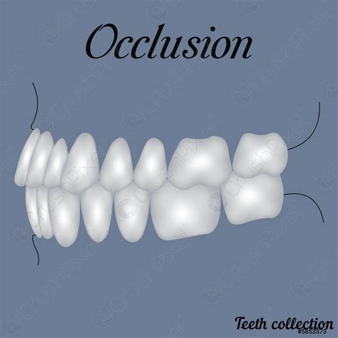 Occlusion Side View Stock Vector 5853373 Crushpixel Occlusion Side View Stock Vector 5853373 Crushpixel