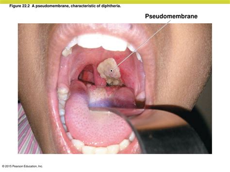 Ppt Microbial Diseases Of The Respiratory System Powerpoint