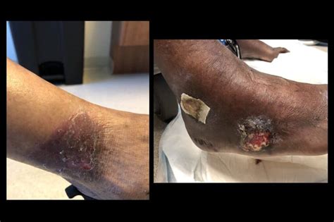 Lower Leg Ulcers Dermatology Advisor