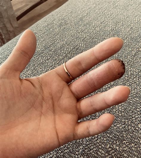 1 Month Post Amputation Getting Easier To Copy With By The Day I Cannot Thank This Community