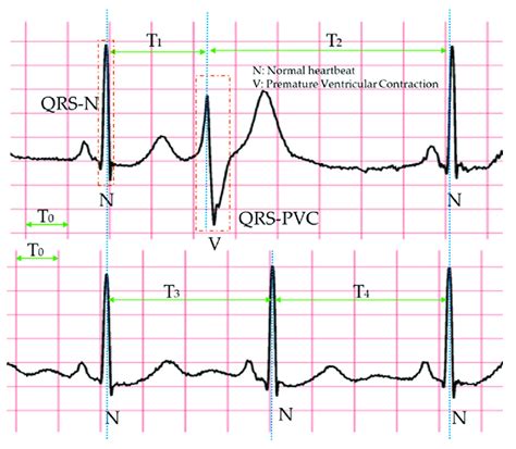 What Premature Ventricular Contraction Pvc Looks Like On 54 Off