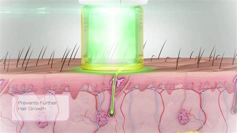 Laser Hair Removal Ozhean