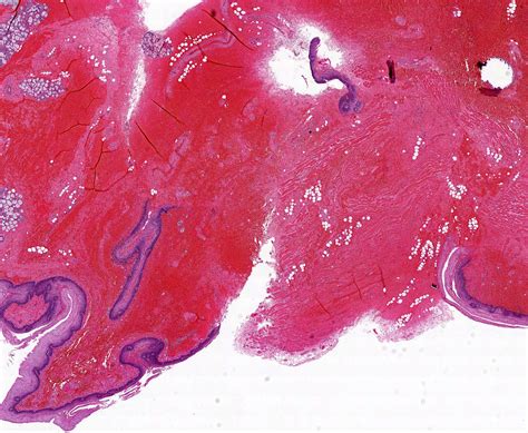 Pathology Outlines Pill Induced Esophagitis