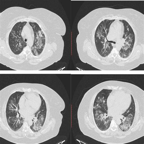 Current Presentation Ct Scan In Upper Lobes Asymmetric Centrilobular Download Scientific