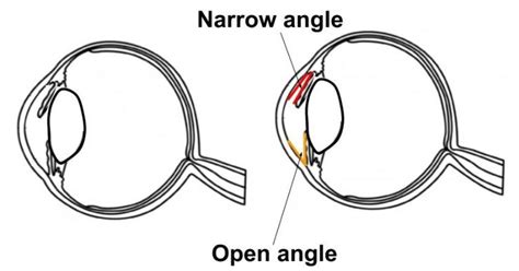 Narrow Angles Neuro Ophthalmology