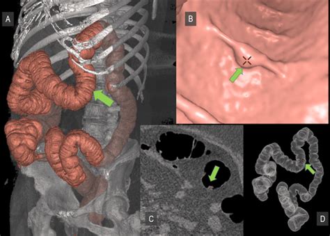 Virtual Colonoscopy 3d And Quantitative Imaging Laboratory