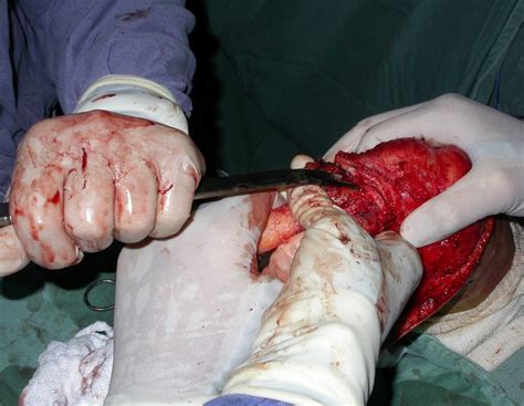 Ewing Sarcoma Of The Tibia Oncosurgery