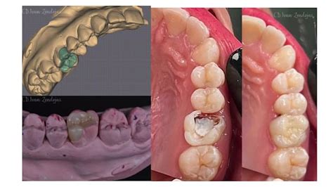 Exocad Professional And Physiofunctional 3d Designs By Ivan Zendejas Fiverr