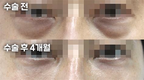 불룩한 눈 밑 지방 제거 없이 재배치로 수술한 30대 후반 남성 10년 젊어짐 부산 케이엔젤 성형외과 Youtube