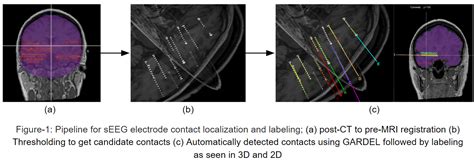 Automatic Seeg Contact Localization And Labeling Using Brainstorm