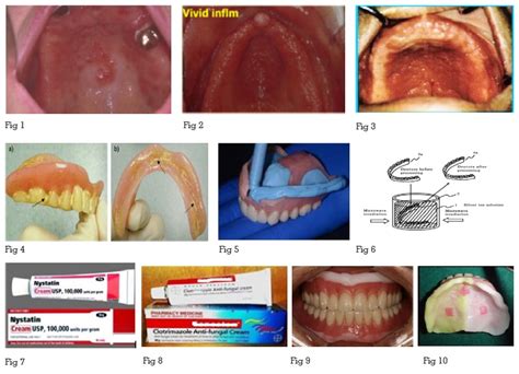 Jpid Vol 03 Issue 02 Ips Kerala Indian Prosthodontic Society Kerala