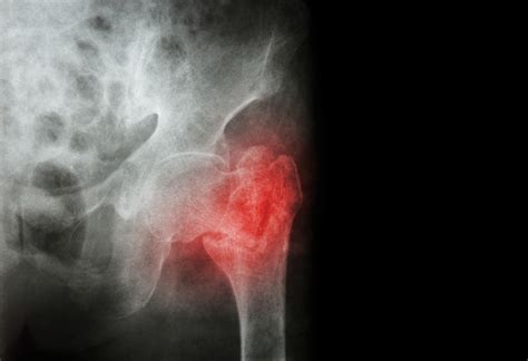 Osteoporosis Care After Hip Fracture Underused By Older Women