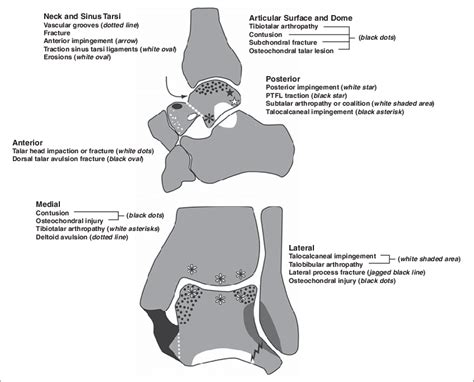 Talus Contusion