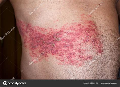 Skin Lesion Symptom Shingles Herpes Zoster Human Shingles Herpes Zoster