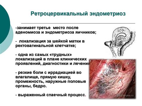 Эндометриоз Распространенность эндометриоза презентация онлайн