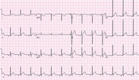 Chapter 1 The Normal Electrocardiogram Thoracic Key