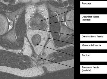 Anterior Mesorectal Fascia