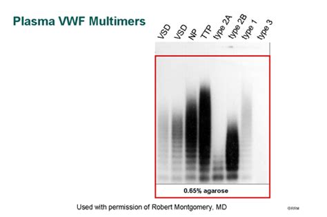 Von Willebrand Disease Pharmacist Role To Better Patient Outcome Transcript