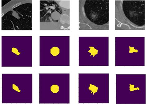 Segmentation Of Large Lung Nodules Typical Examples Of Original Image Download Scientific