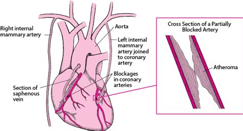 Imagecoronary Artery Bypass Grafting Msd Manual Consumer Version