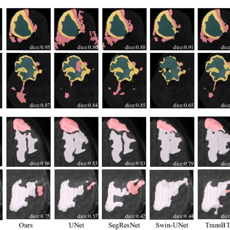 Quantitative Comparison On Brats 2020 Dataset Download Scientific Diagram