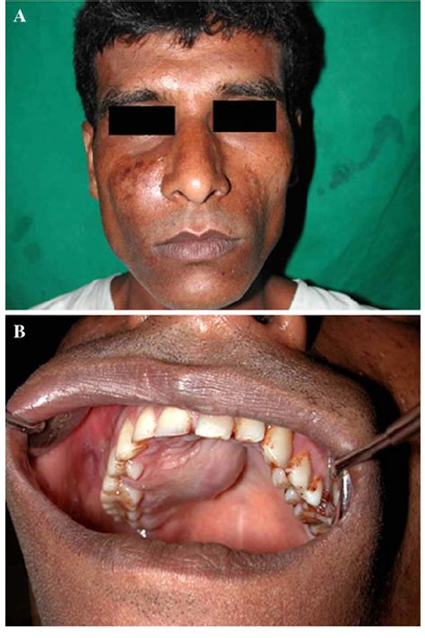 A Solitary Diffuse Extra Oral Swelling On The Right Side Of Face Download Scientific Diagram