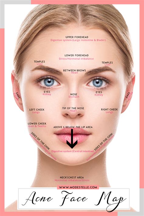 Acne Face Chart Kristinacarrillo