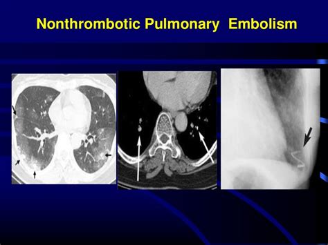 Imaging Of Pulmonary Embolism