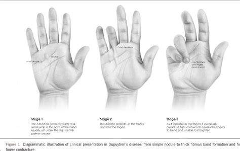Figure 1 From Management Of Dupuytrens Disease Clear Advice For An
