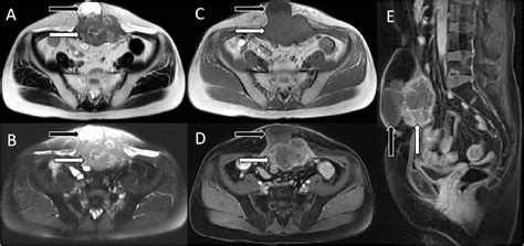 Solitary Abdominal Muscle Metastasis Of Cervical Cancer After Surgery Mimicking Mesenchymal
