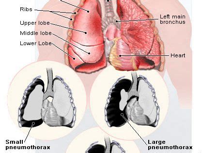Picture Of Collapsed Lung Pneumothorax Tracheal Shift From Midline