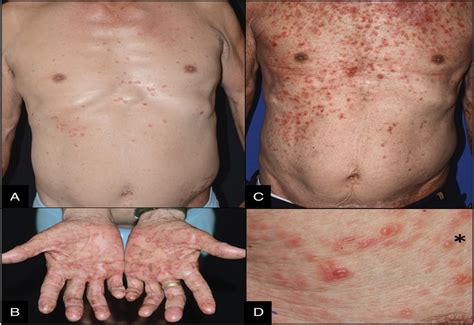 Vesicular Lymphomatoid Papulosis With Dusp22 Irf4 Rearrangem The