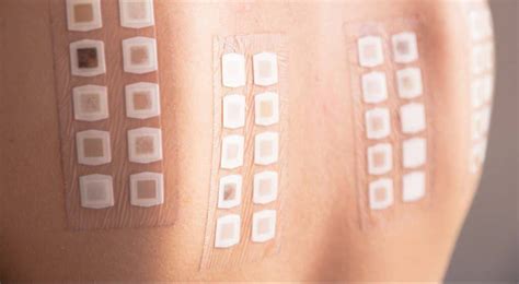 Patch Testing Cahaba Dermatology And Skin Health Center