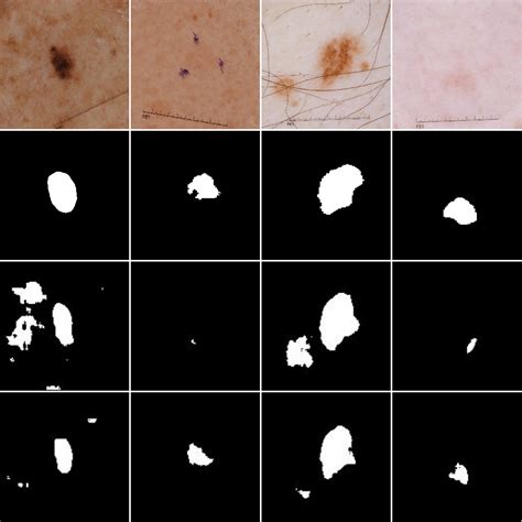 Mask2lesion Mask Constrained Adversarial Skin Lesion Image Synthesis