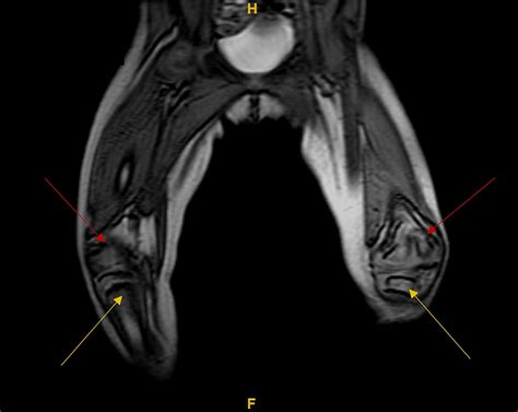 Magnetic Resonance Imaging Of The Bilateral Lower Limbs Without Download Scientific Diagram