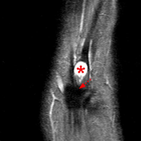 Stenosing Tenosynovitis Of The 4th Extensor Compartment Radsource