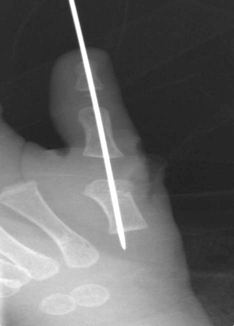 Figure 1 From Correction Of Wassel Type Iv Thumb Duplication With Zigzag Deformity Results Of A