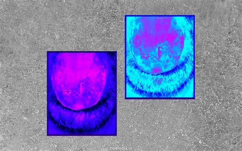 Tongue Lesions With Redness And Painful Erosions And Ulcers Cme India