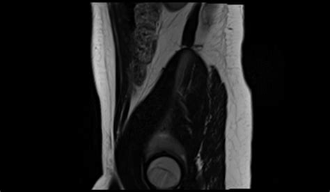 Appendix Mri T2 Tse Sagittal Images