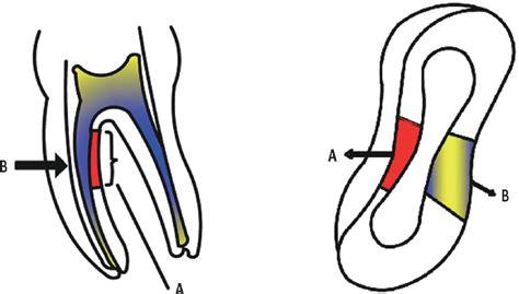 Figure 1 From Detection Of Root Perforations Using Conventional And Digital Intraoral