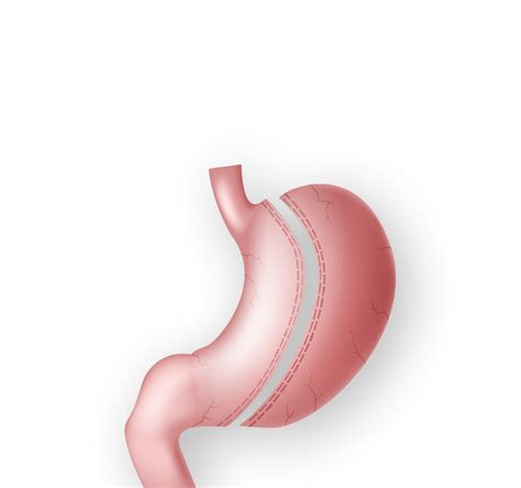 Gastric Sleeve Surgery By Weight Loss Team In Puerto Vallarta